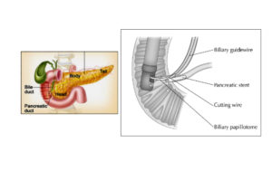 Endoscopic Retrograde Cholangio-Pancreatography (ERCP) – Gastrocare ...